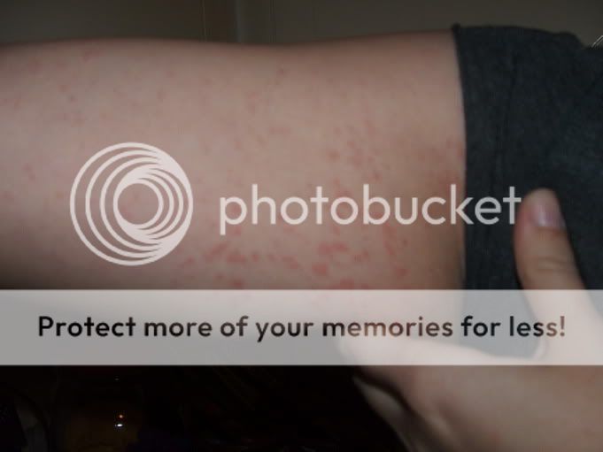 Itchy Rash Lamictal Lamotrigine | zuzyhi24のブログ